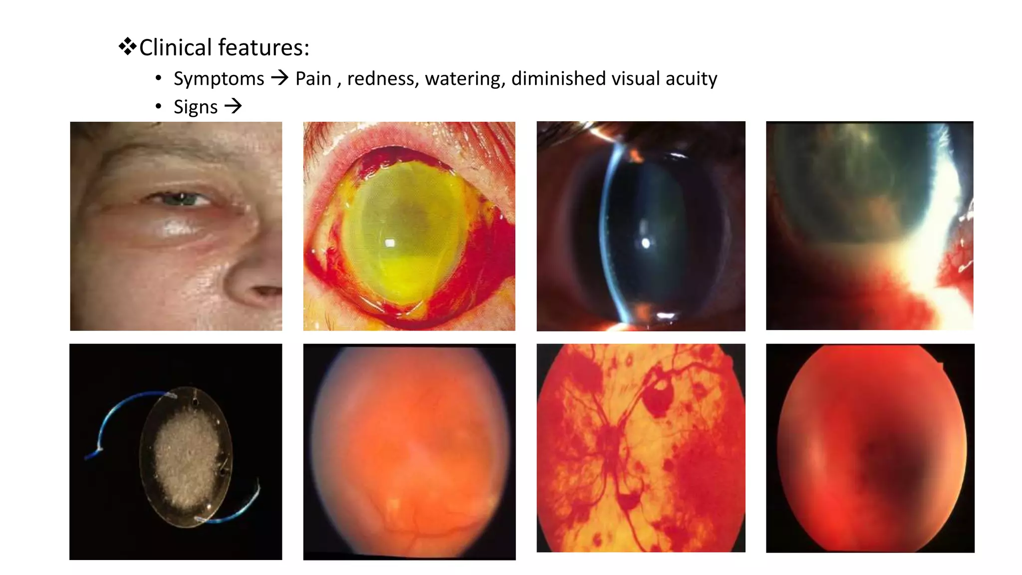 Cataract surgery types and per, early post op and late post op ...
