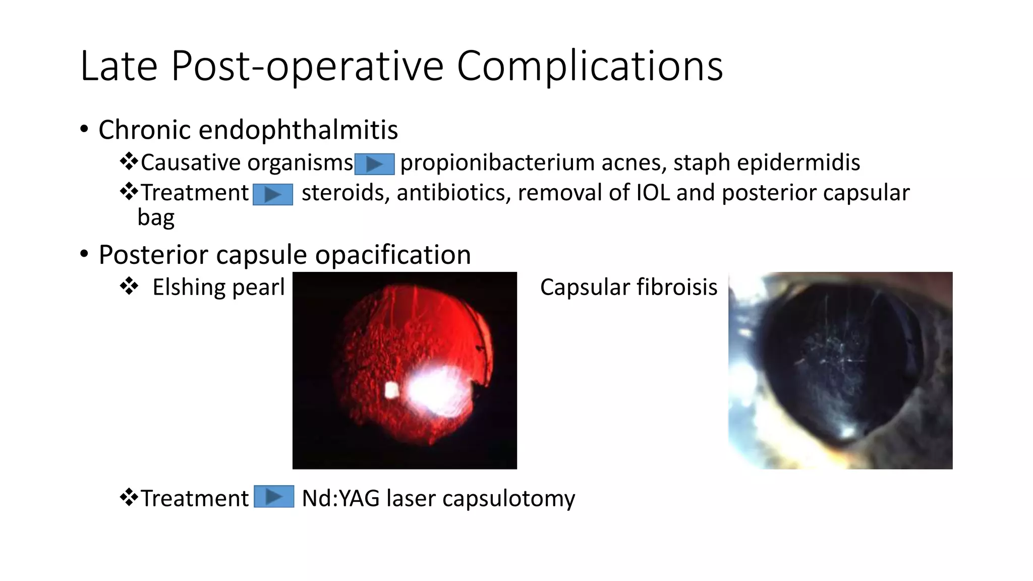 Cataract surgery types and per, early post op and late post op ...