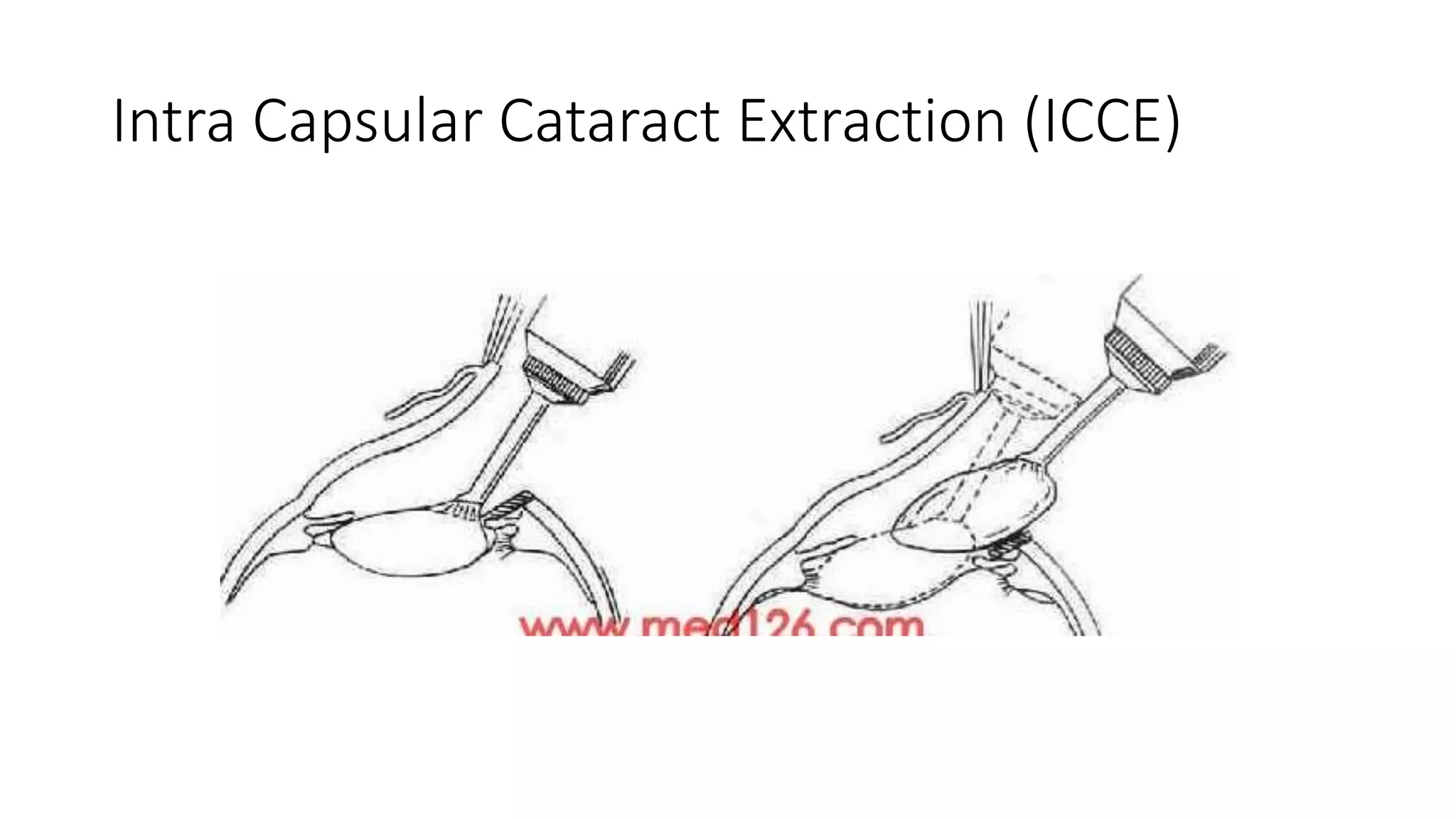 Cataract surgery types and per, early post op and late post op ...
