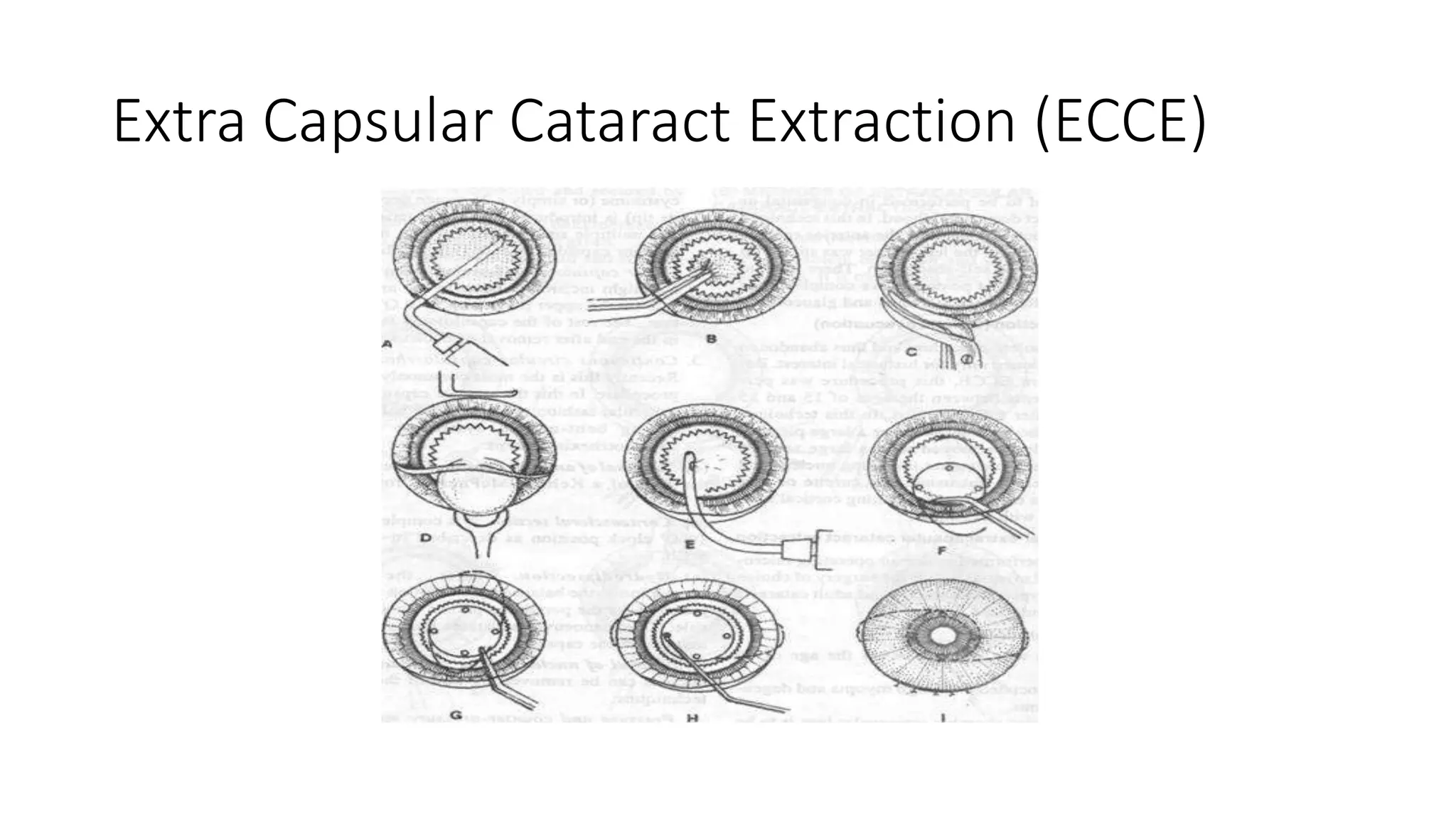 Cataract surgery types and per, early post op and late post op ...