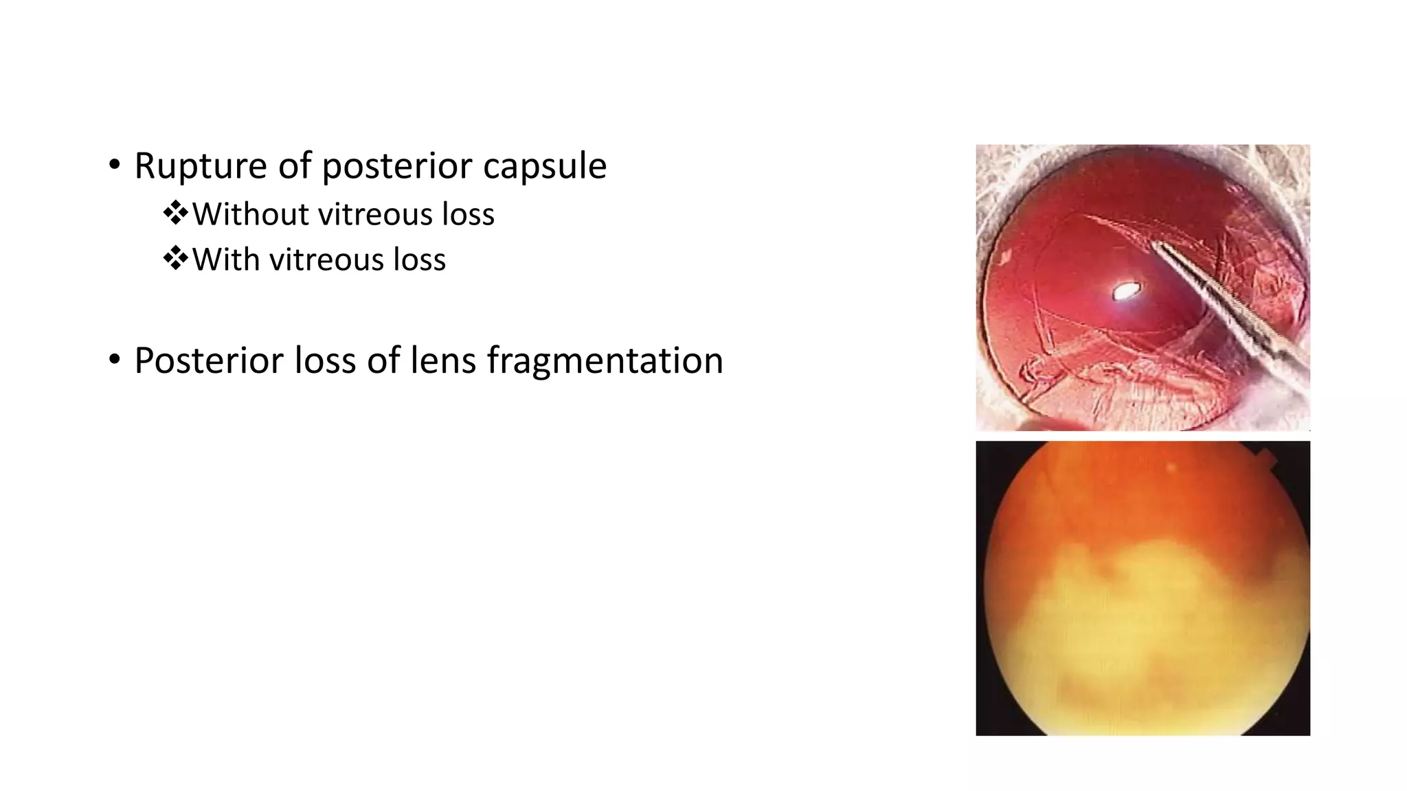 Cataract surgery types and per, early post op and late post op ...
