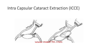 Cataract surgery types and per, early post op and late post op ...