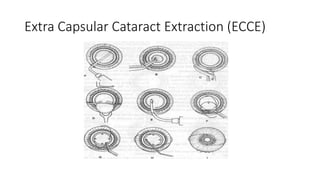 Cataract surgery types and per, early post op and late post op ...
