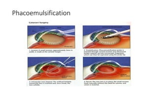 Cataract surgery types and per, early post op and late post op ...