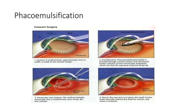 Cataract surgery types and per, early post op and late post op ...