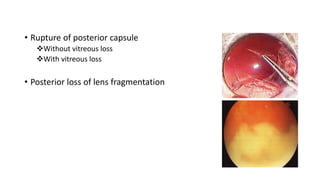 Cataract surgery types and per, early post op and late post op ...
