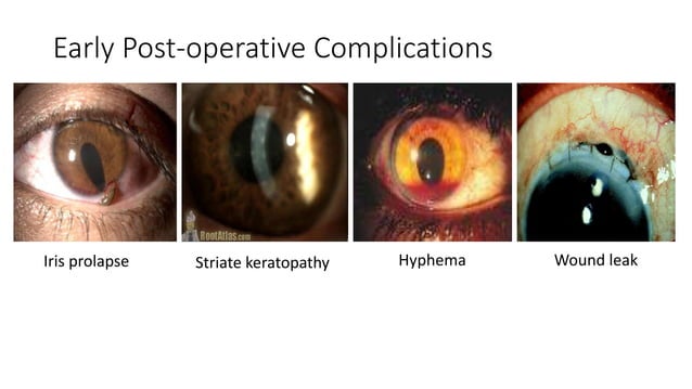 Cataract surgery types and per, early post op and late post op ...