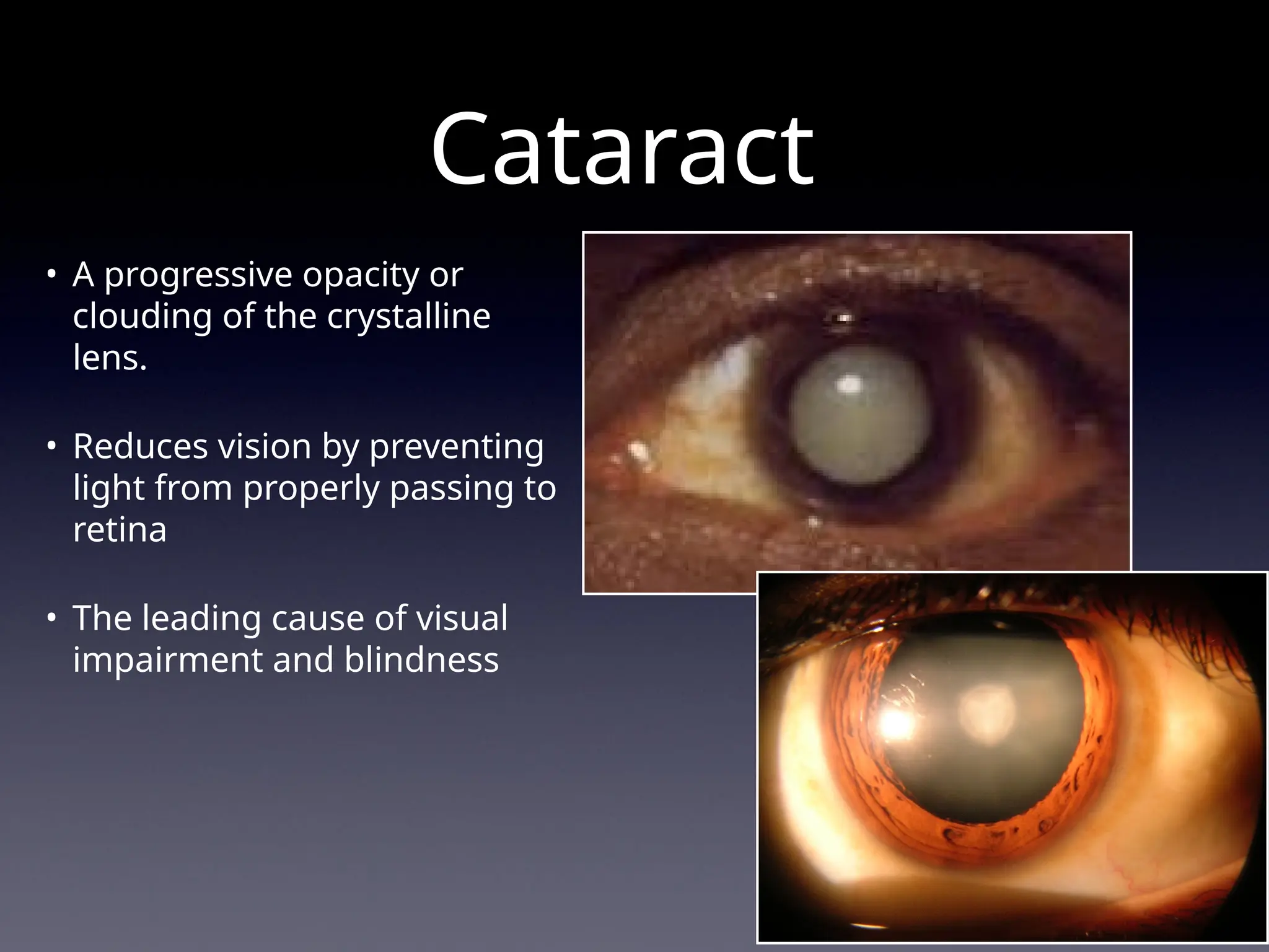 Cataract and Glaucoma disease of the eyeppt | PPT