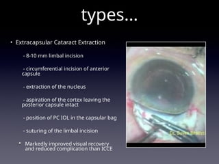 Cataract and Glaucoma disease of the eyeppt | PPT | Free Download