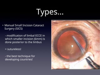 Cataract and Glaucoma disease of the eyeppt | PPT