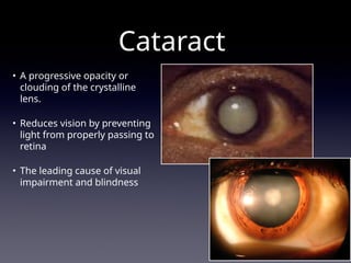 Cataract and Glaucoma disease of the eyeppt | PPT | Free Download