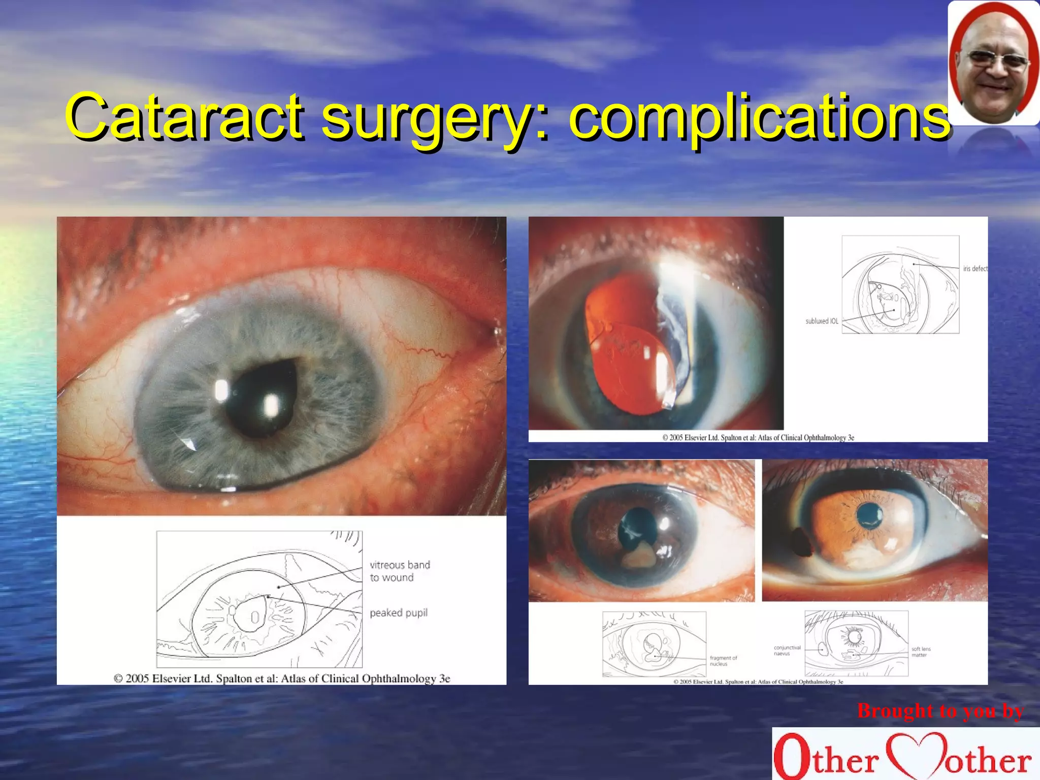 Cataract and implant surgery | PPT