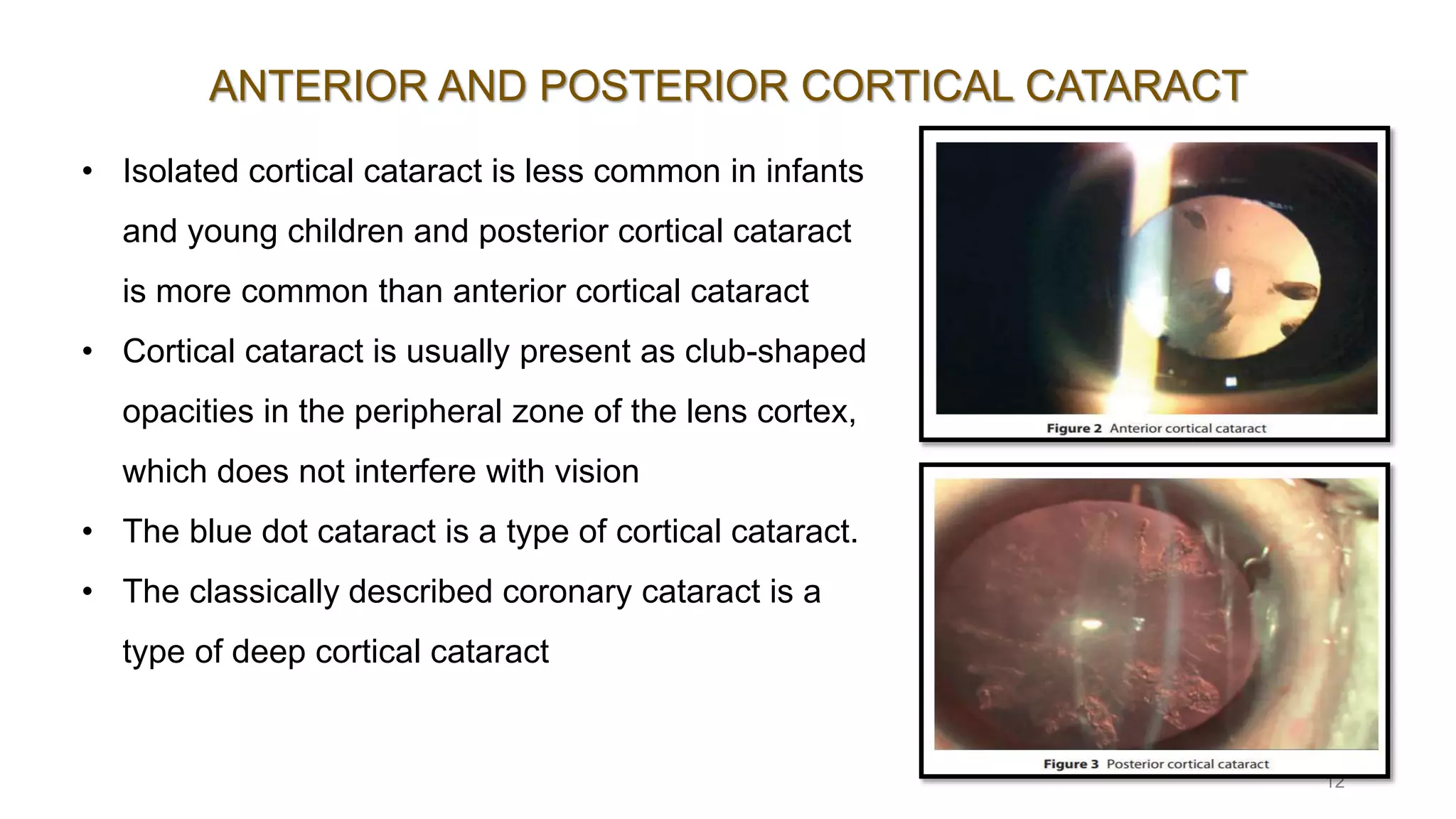 CATARACT, ANISOCORIA AND OCCULAR INJURIES.pptx | Death, Injury, or ...