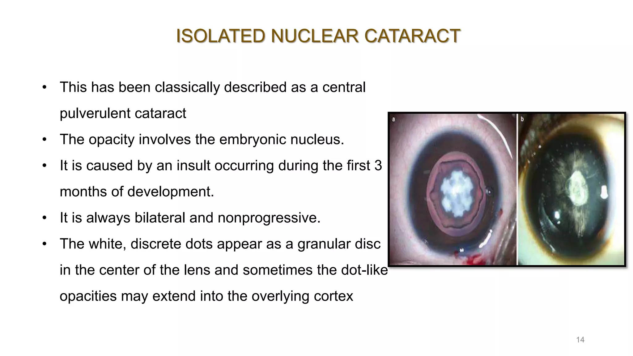 CATARACT, ANISOCORIA AND OCCULAR INJURIES.pptx | Death, Injury, or ...