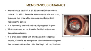 CATARACT, ANISOCORIA AND OCCULAR INJURIES.pptx | Death, Injury, or ...