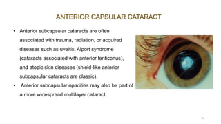 Anterior Capsular Cataract