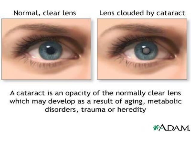 Cataract card | PPT