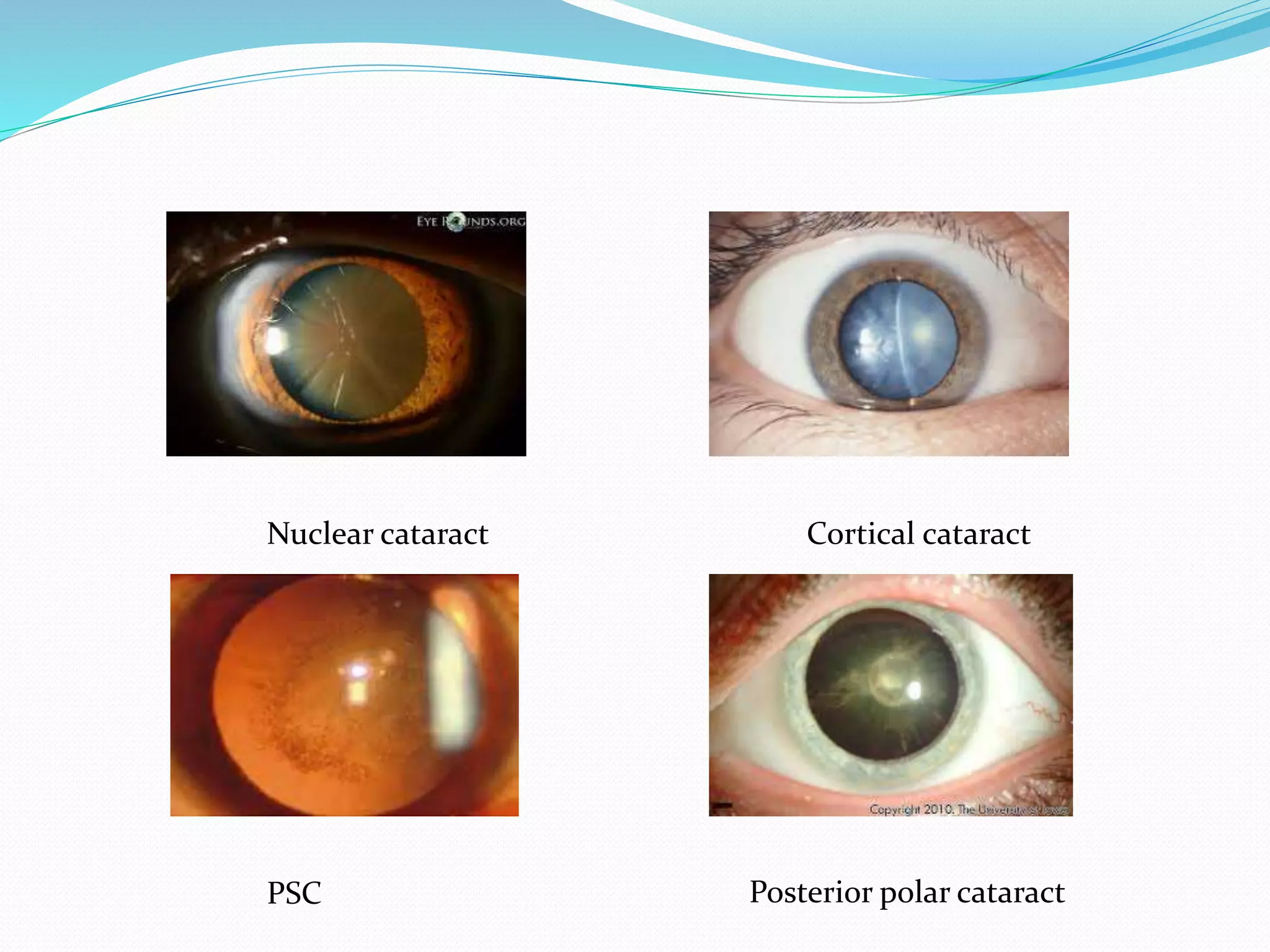 Cataract evaluation ppt | PPTX