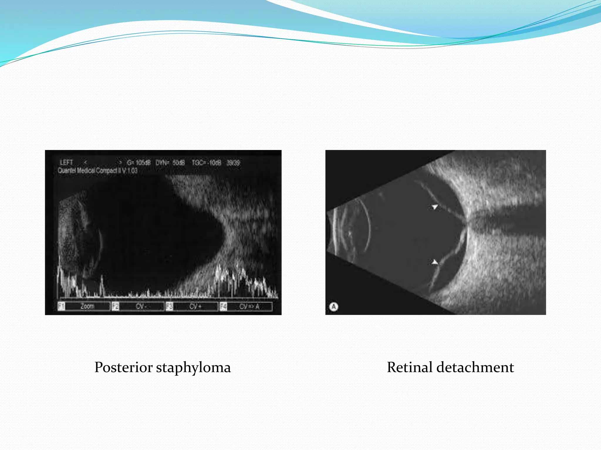 Cataract evaluation ppt | PPTX