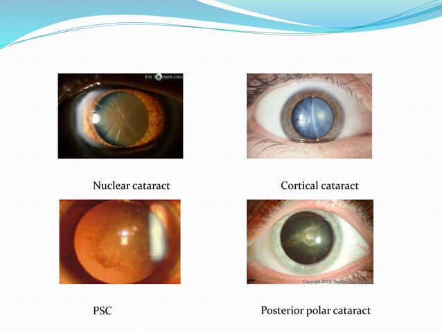 Cataract Evaluation Ppt Pptx