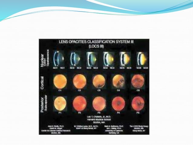 Cataract Evaluation Ppt Pptx