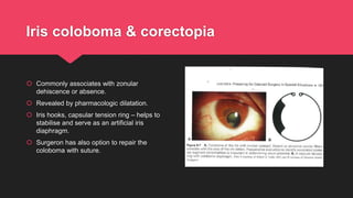 Cataract extraction (manual) and cataract surgery | PPTX