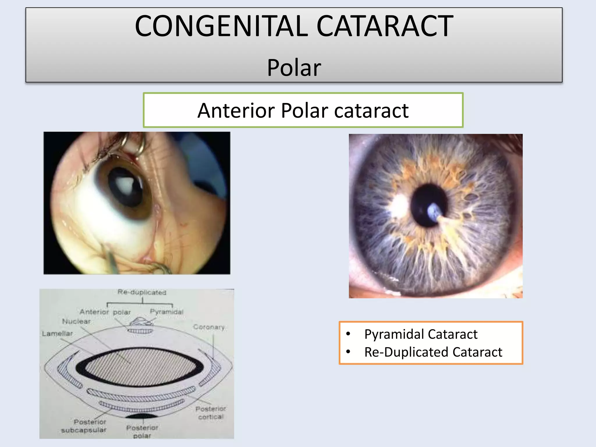 Types Of Cataract | PPTX