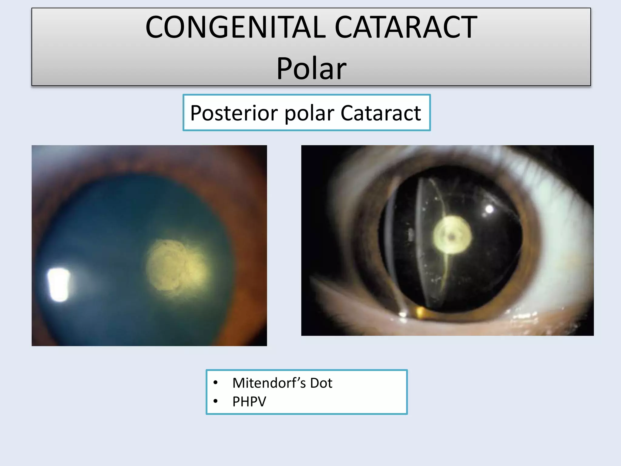 Types Of Cataract | PPTX
