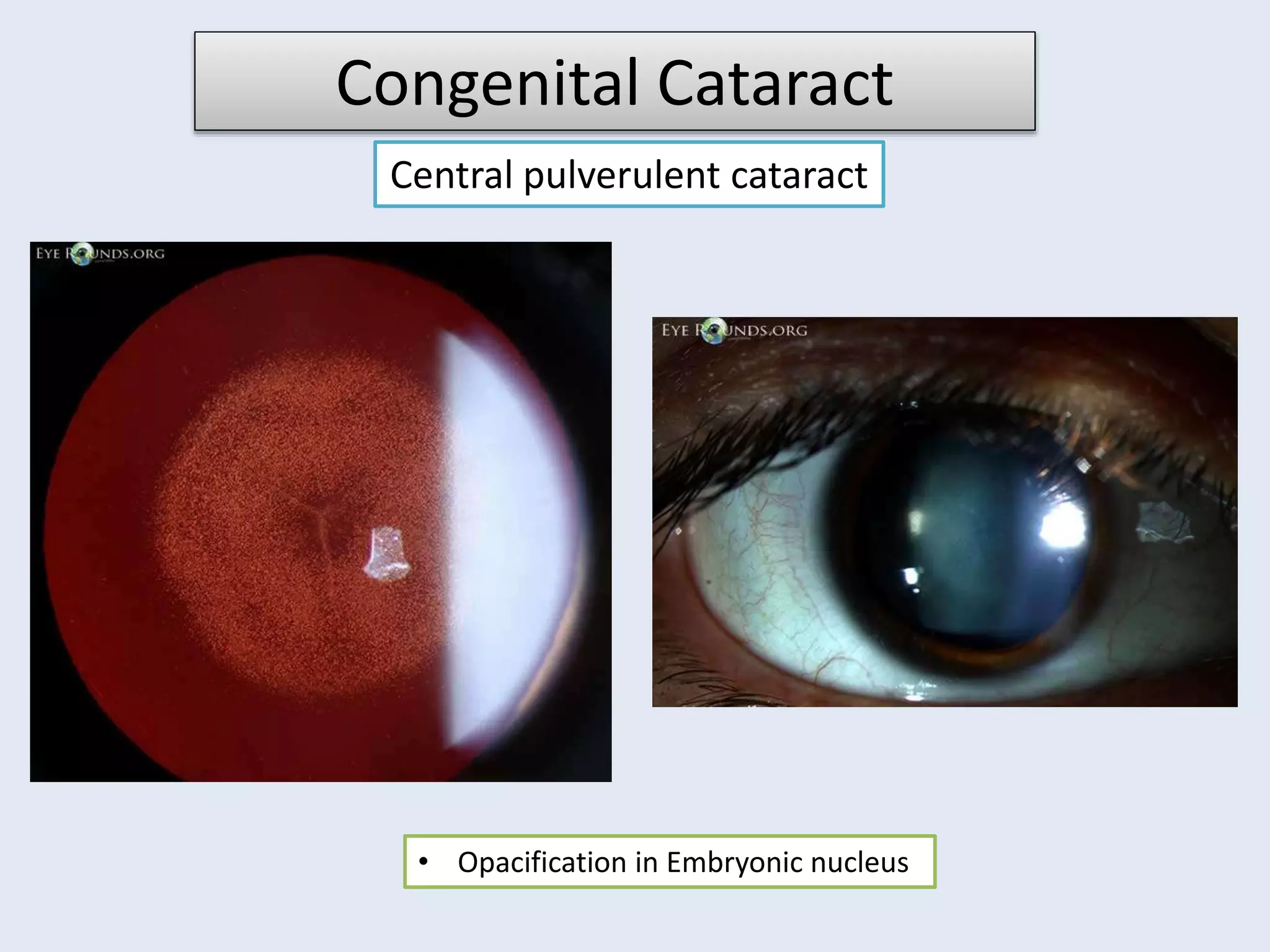 Types Of Cataract | PPTX