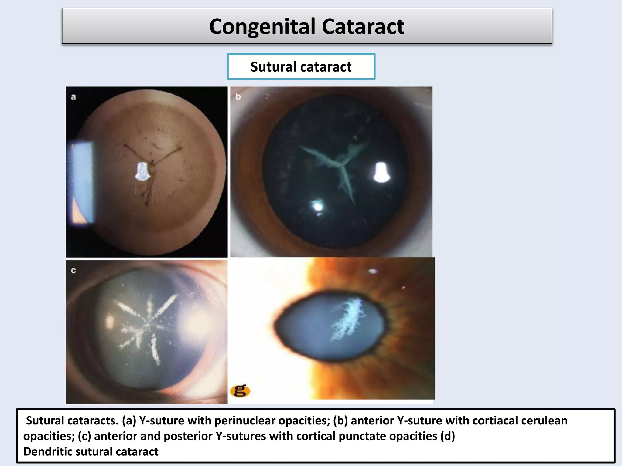 Types Of Cataract | PPTX