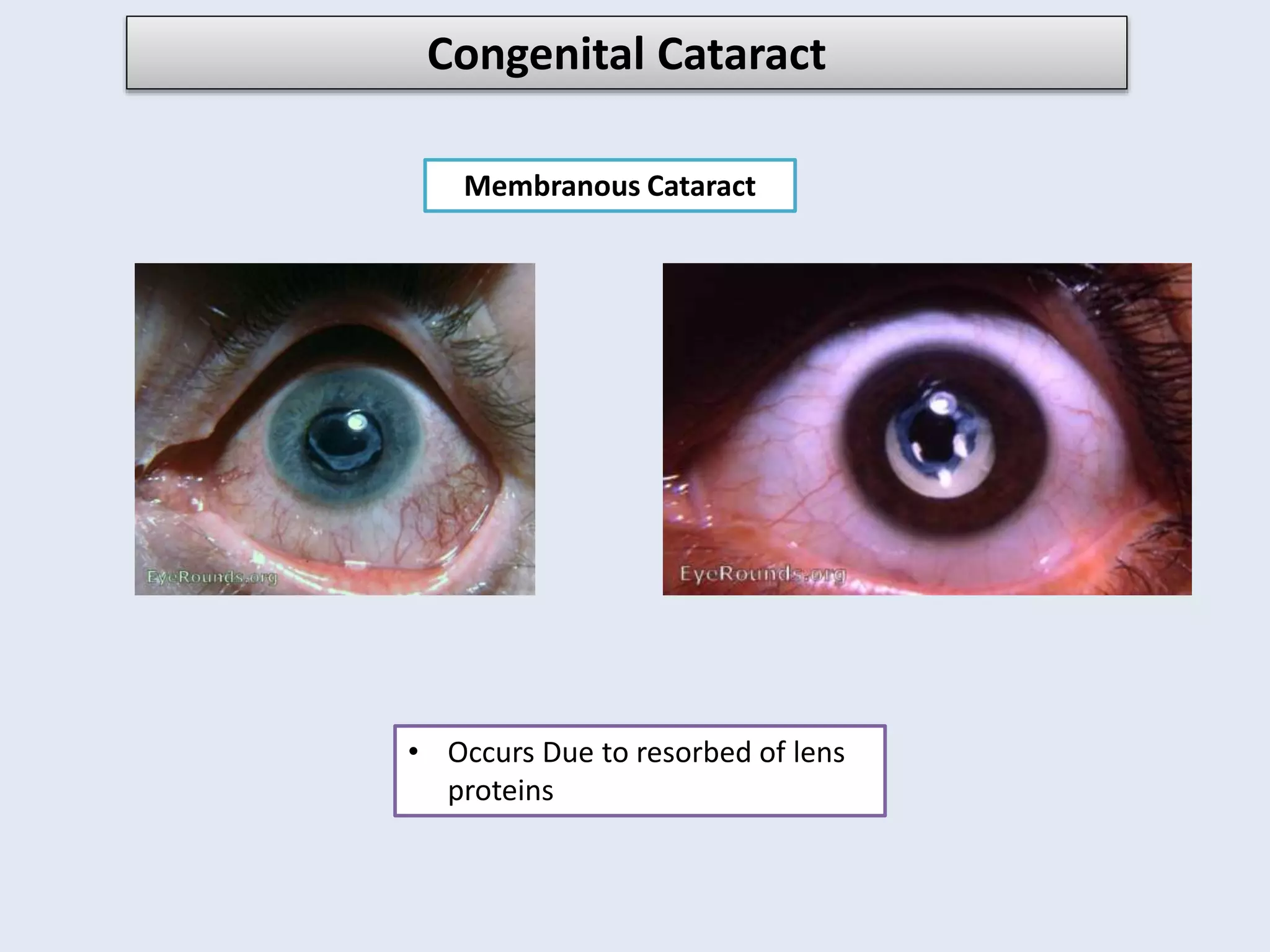 Types Of Cataract | PPTX