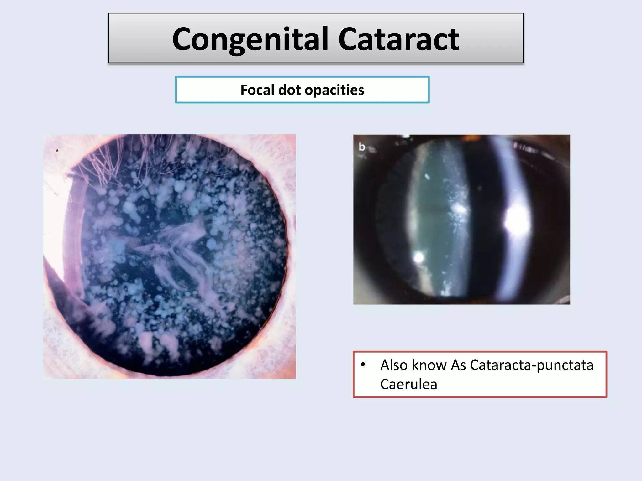 Types Of Cataract | PPTX
