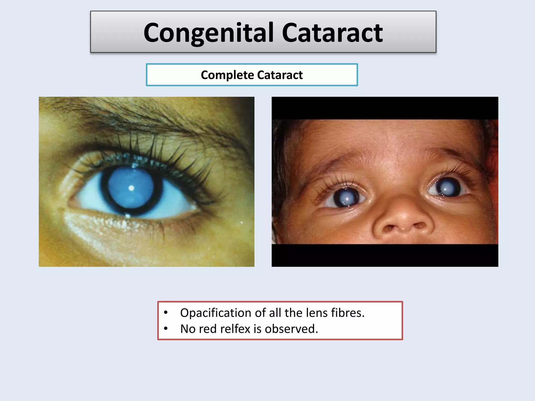 Types Of Cataract | PPTX