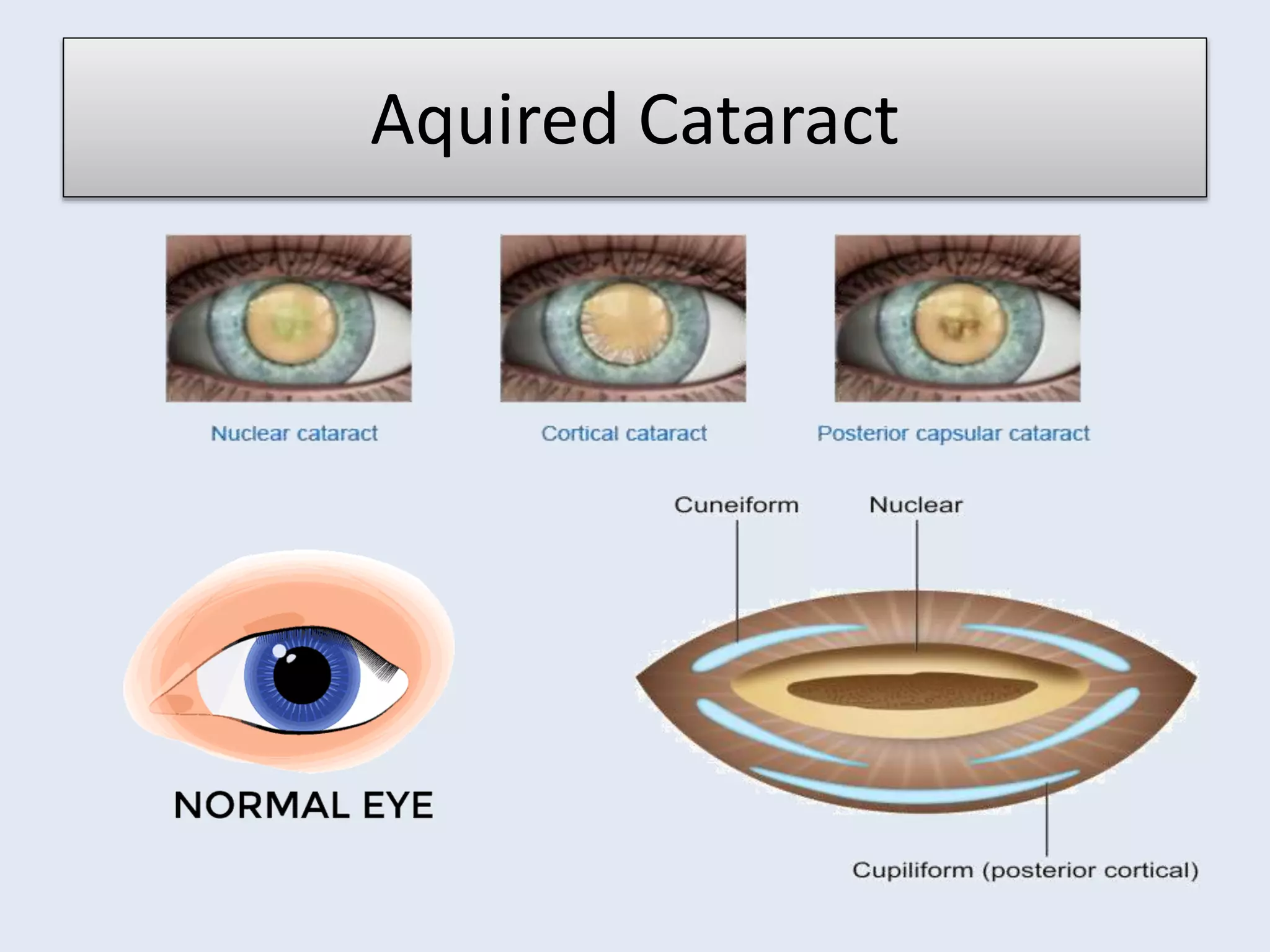 Types Of Cataract | PPTX