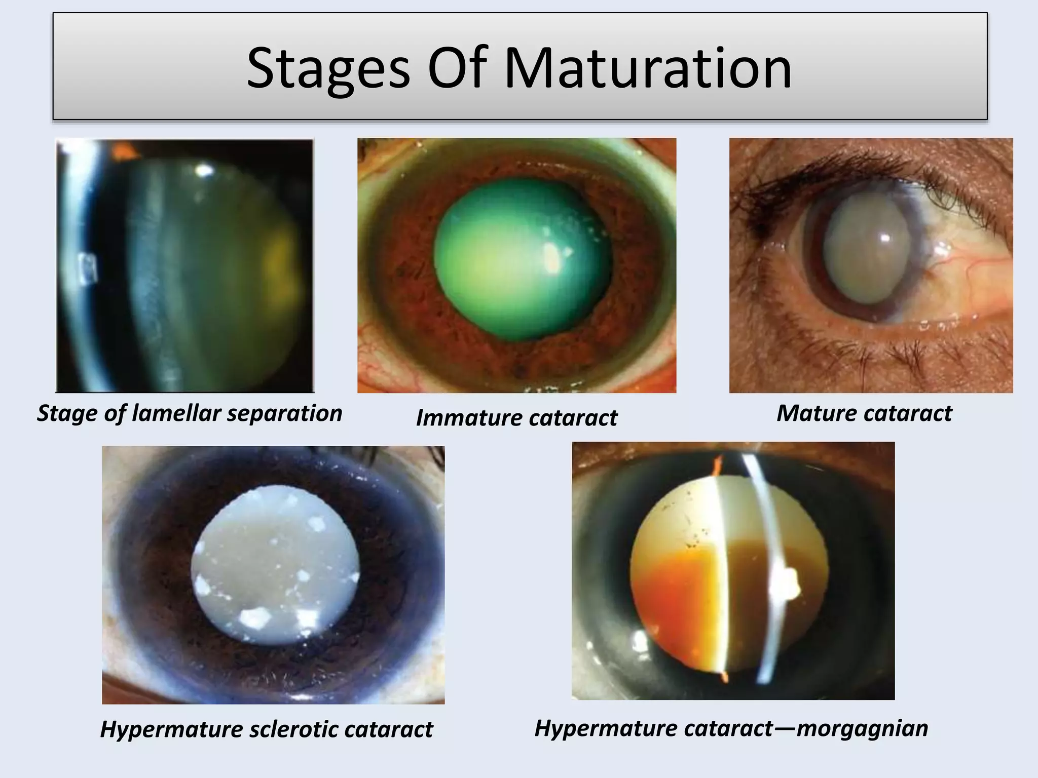 Types Of Cataract | PPTX