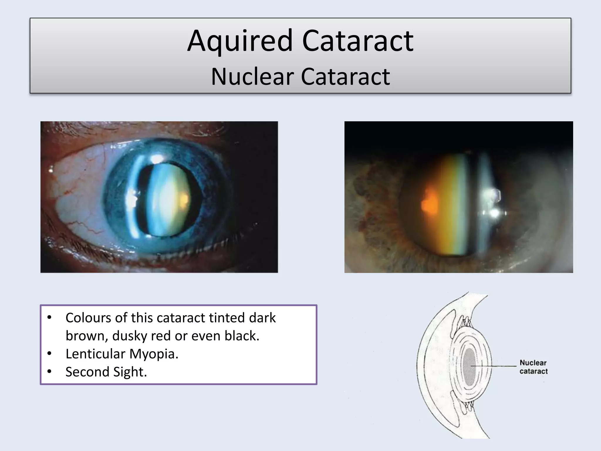 Types Of Cataract | PPTX