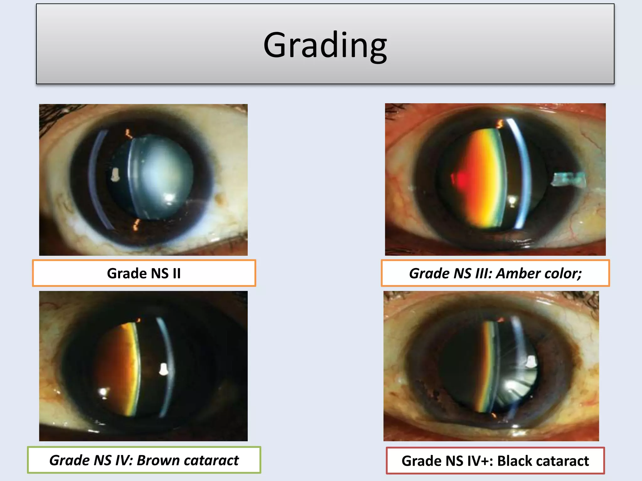 Types Of Cataract | PPTX