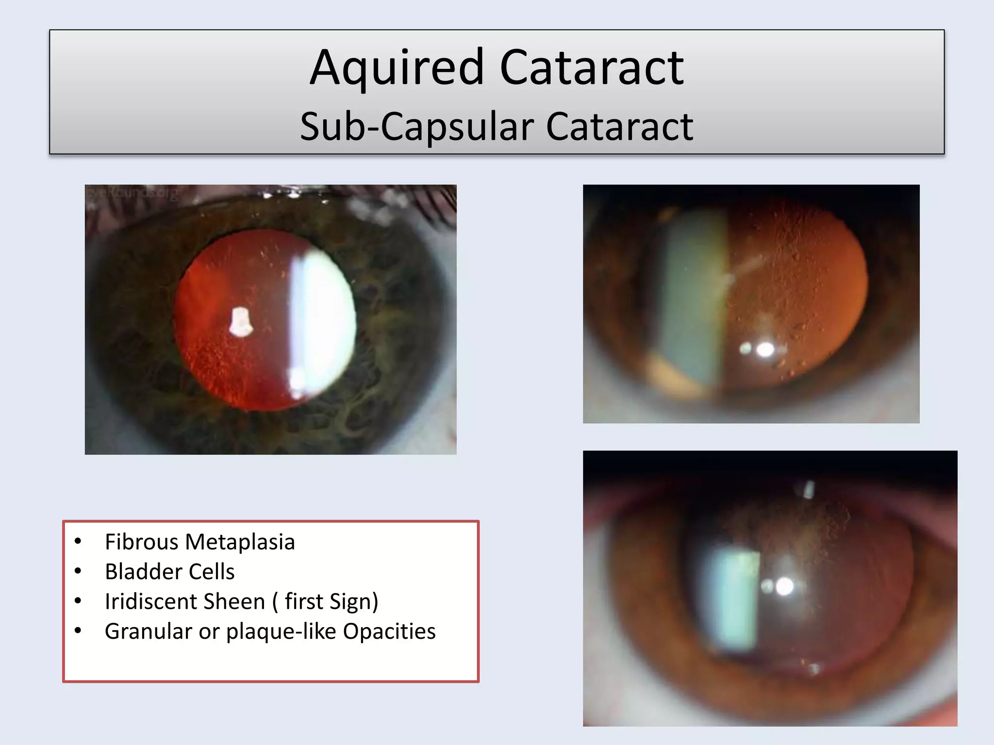 Types Of Cataract | PPTX