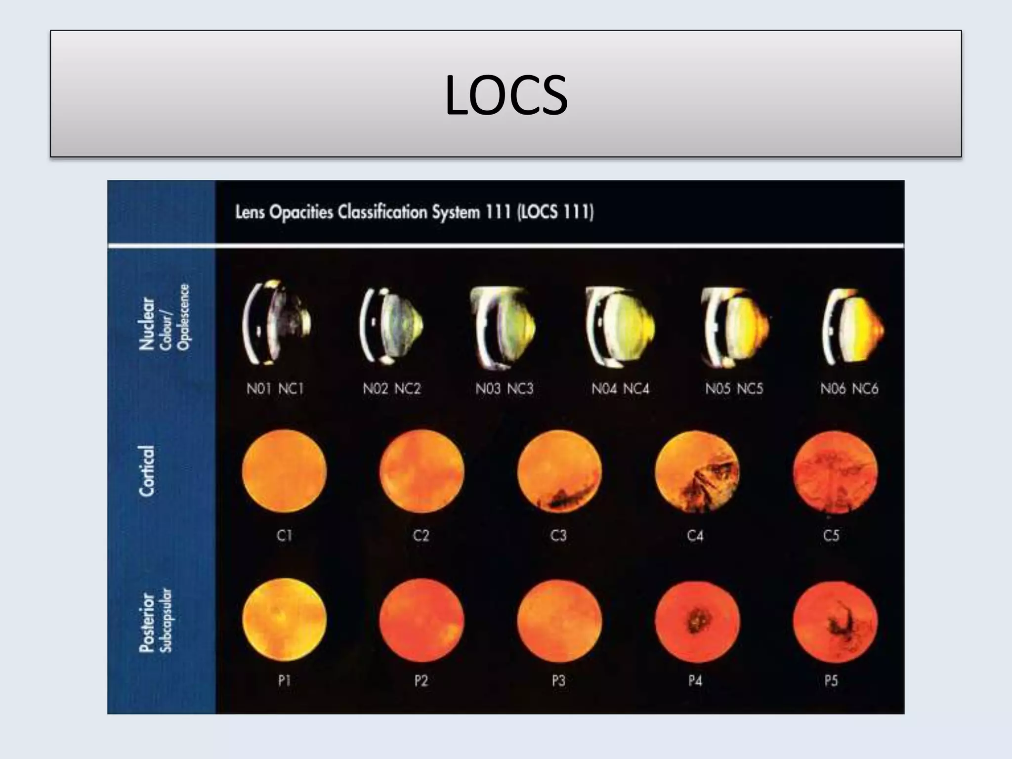 Types Of Cataract | PPTX
