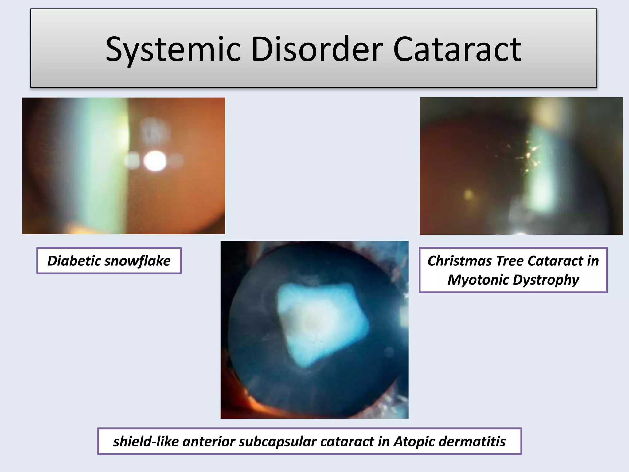 Types Of Cataract | PPTX