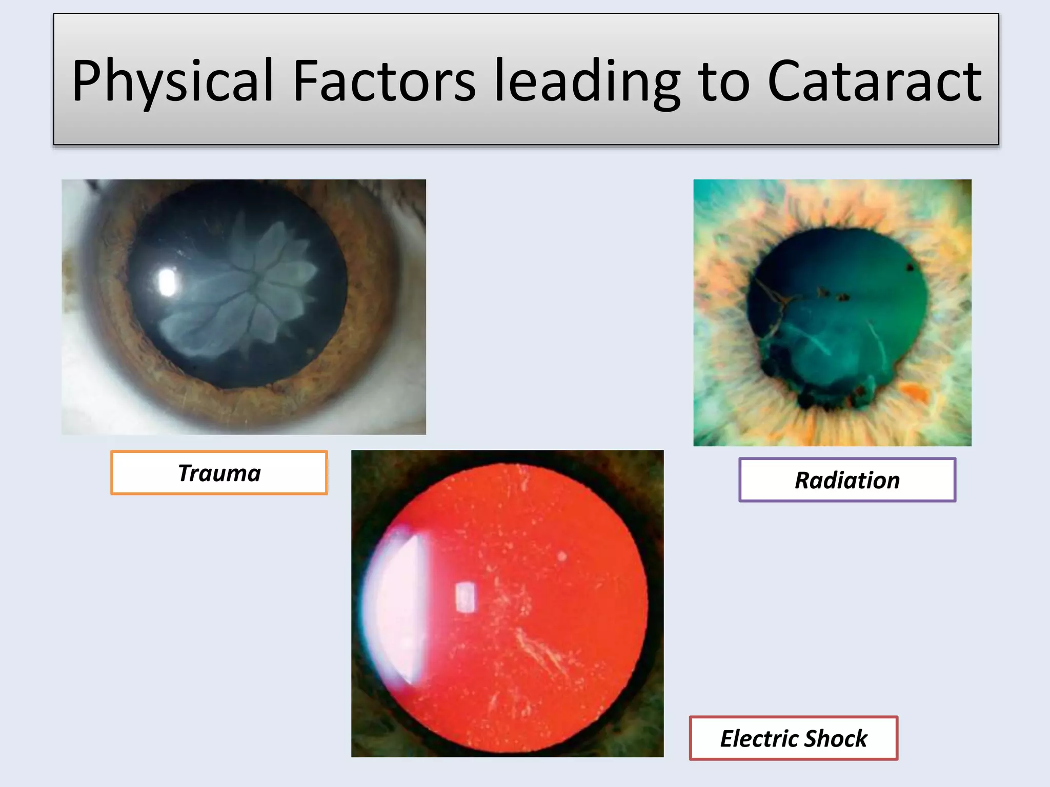 Types Of Cataract | PPTX
