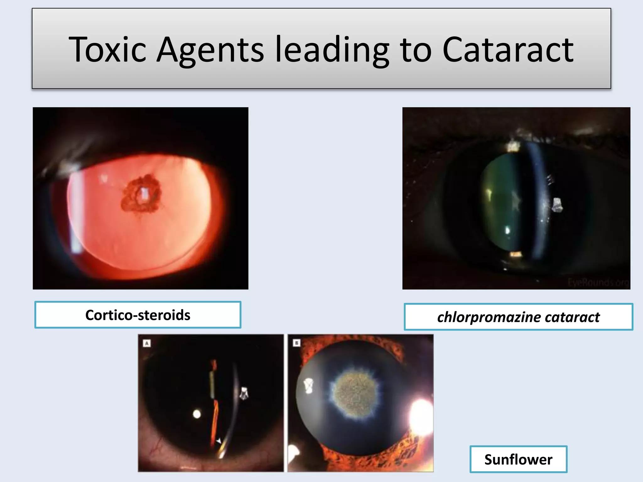 Types Of Cataract | PPTX