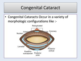 Types Of Cataract | PPTX