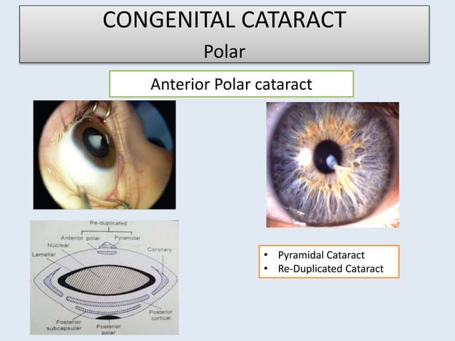 Types Of Cataract | PPTX