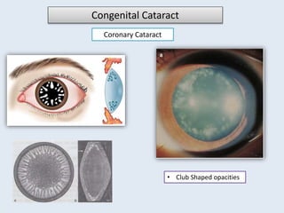 Types Of Cataract | PPTX