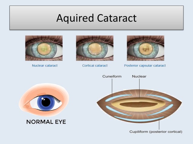 Types Of Cataract | PPTX