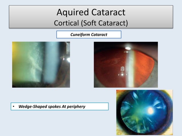 Types Of Cataract | PPTX