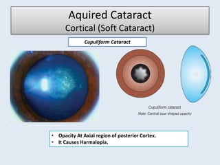 Types Of Cataract | PPTX