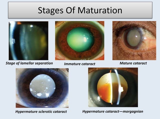 Types Of Cataract | PPTX