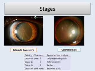 Types Of Cataract | PPTX